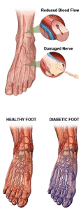 Diabetic Neuropathy - Family Podiatry and Vein Care • Gainesville, FL