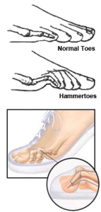 Hammertoes - Family Podiatry and Vein Care • Gainesville, FL